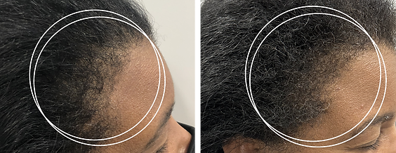 SmartLux Treatment | BENEV